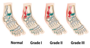 Ligament Laxity Treatment | Boston Foot Ankle Biologics