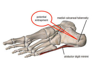 Baxter’s Nerve Entrapment Treatment | Boston Foot Ankle Biologics