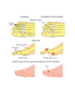 Plantar Plate Tear Treatment | Boston Foot And Ankle Biologics